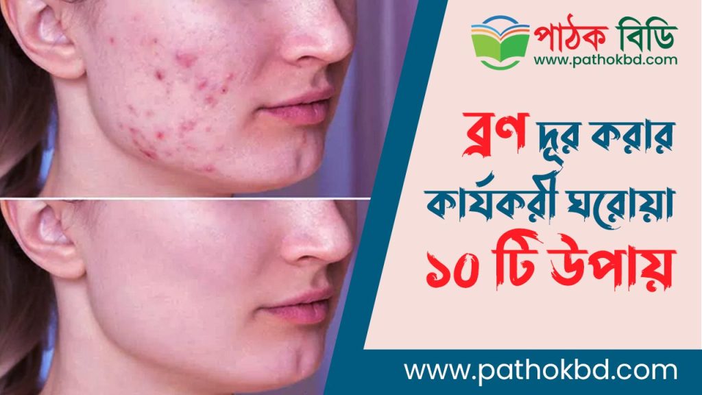 ব্রণ দূর করার উপায়, ১০ টি কার্যকরি ঘরোয়া পদ্ধতি | Pathok BD